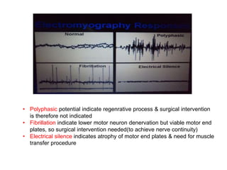 facial nerve- pathophysiology, electrodiagnostic and imaging | PPTX