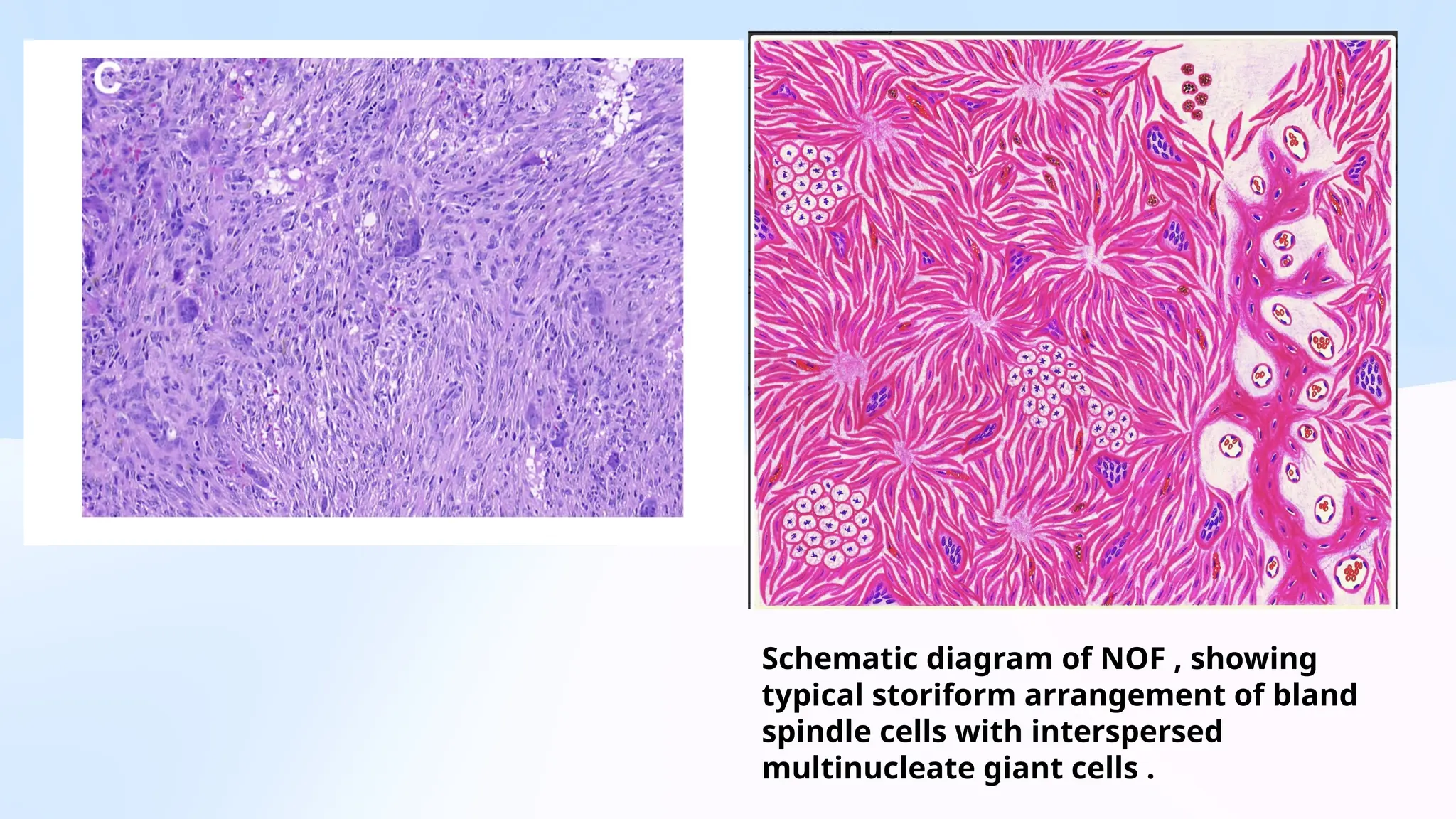 Giant cell tumor pathology Final ppt GCT 19:5.pptx
