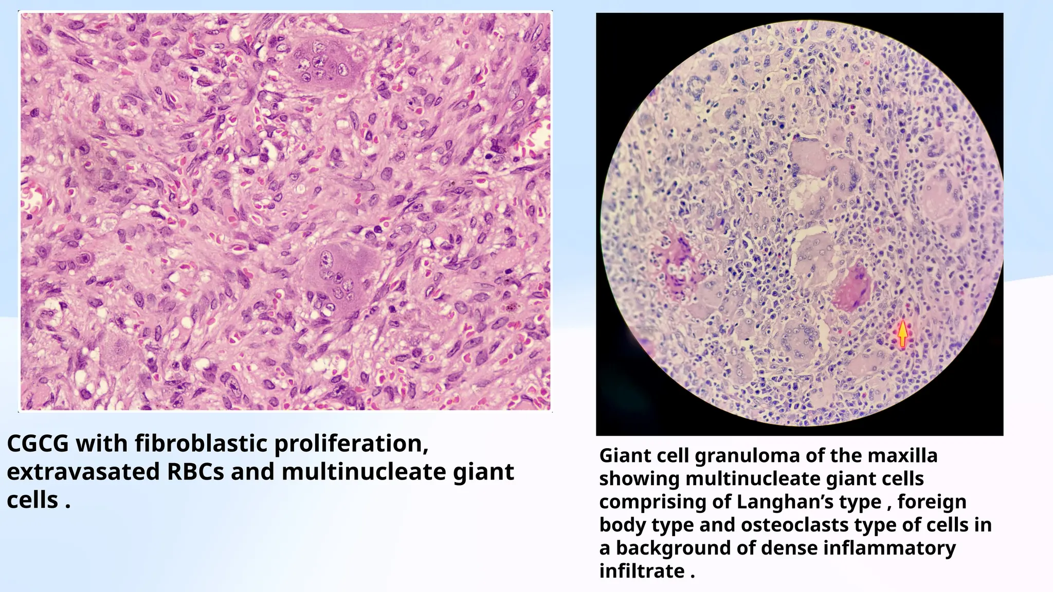 Giant cell tumor pathology Final ppt GCT 19:5.pptx