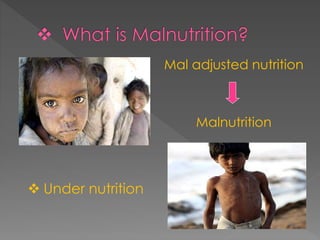 Malnutrition | PPTX