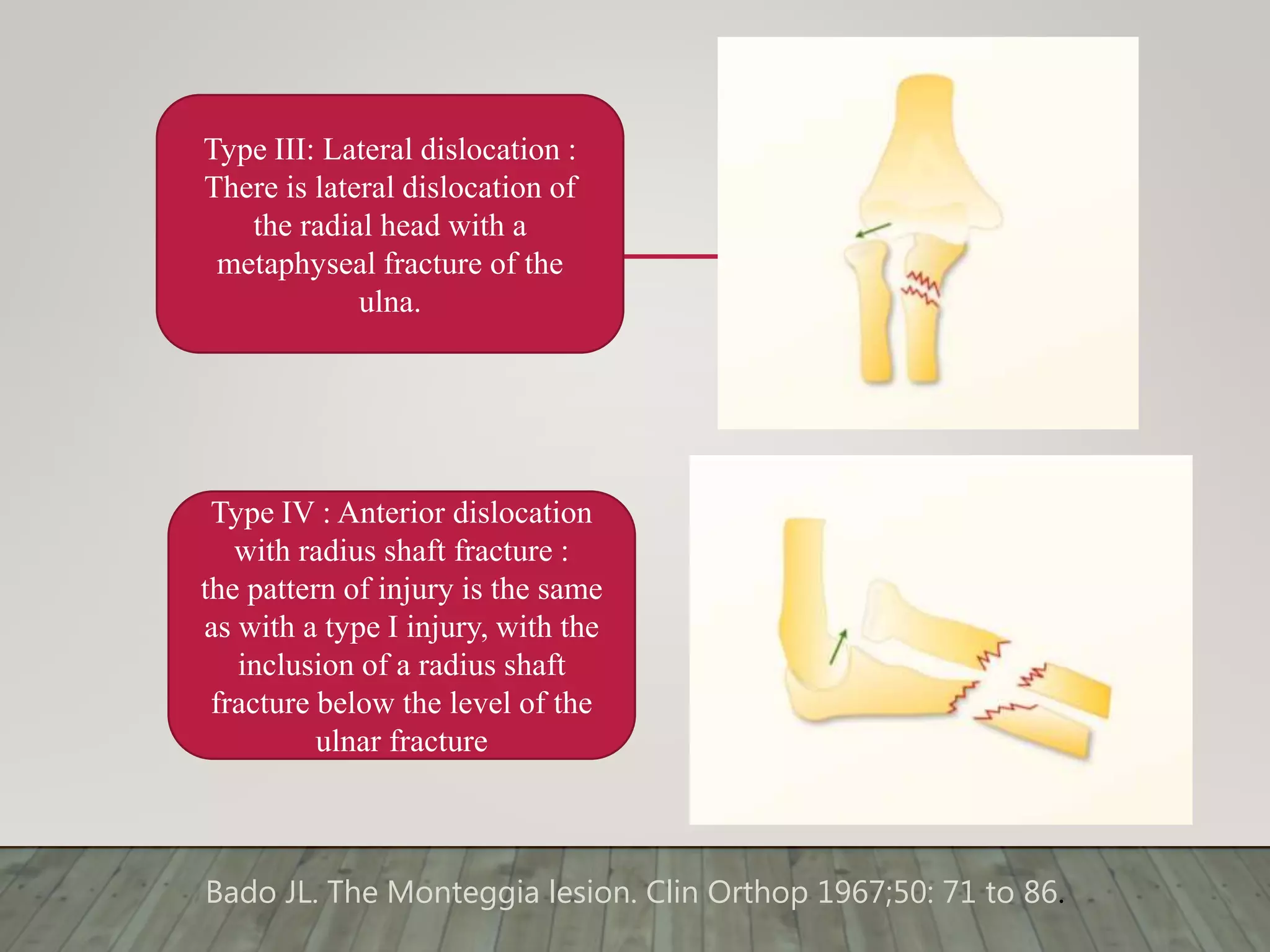 Monteggia fracture dislocation | PPTX