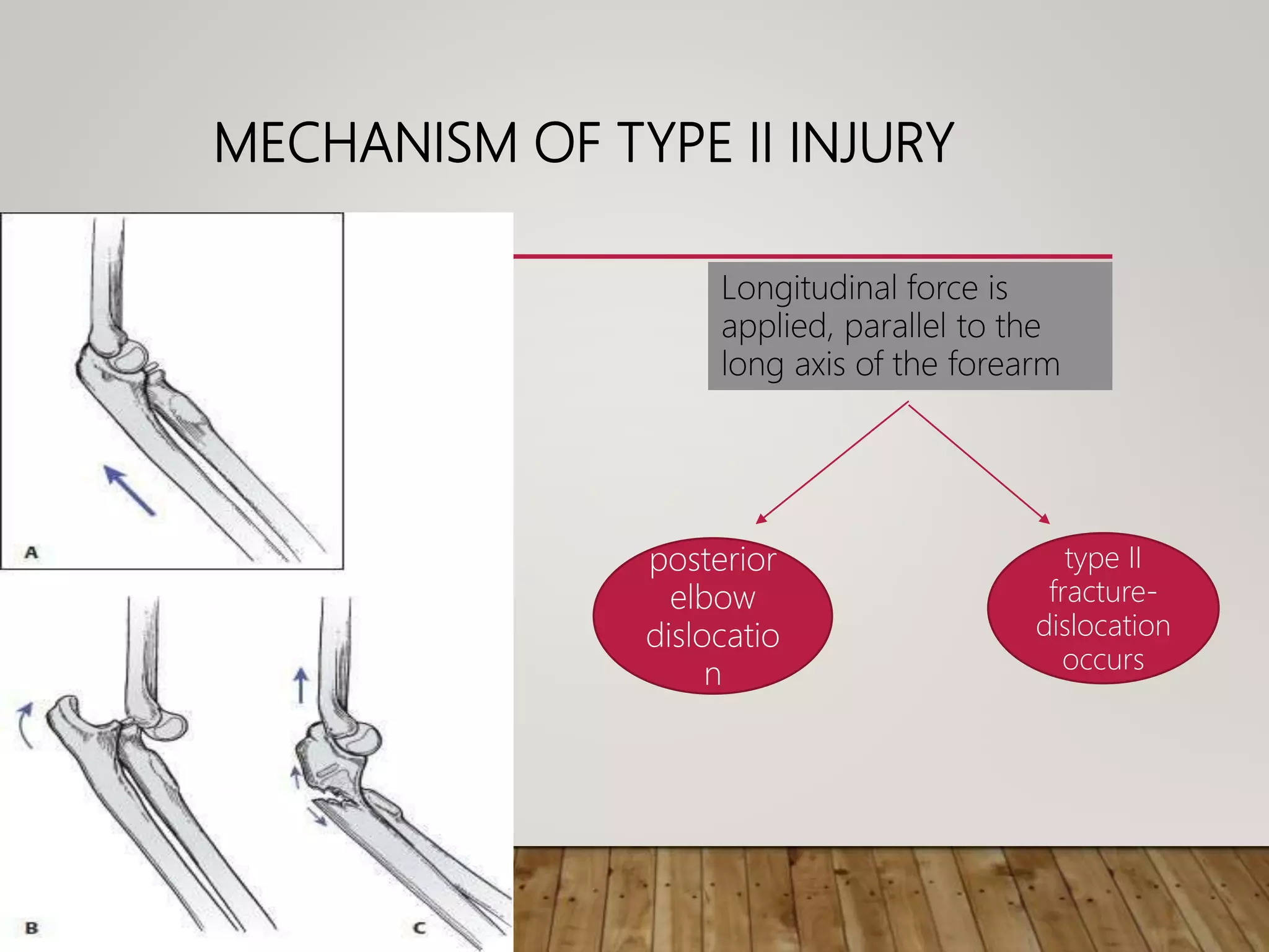 Monteggia fracture dislocation | PPTX