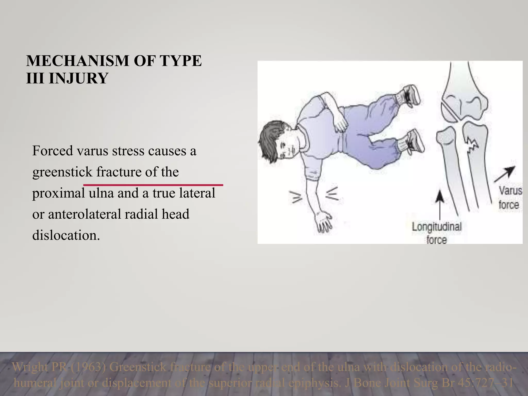 Monteggia fracture dislocation | PPTX