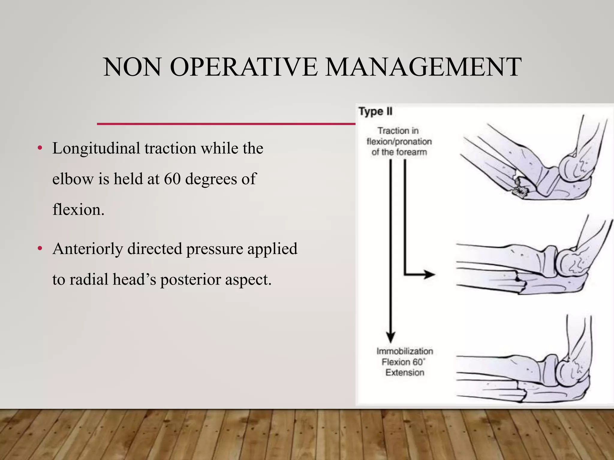 Monteggia fracture dislocation | PPTX
