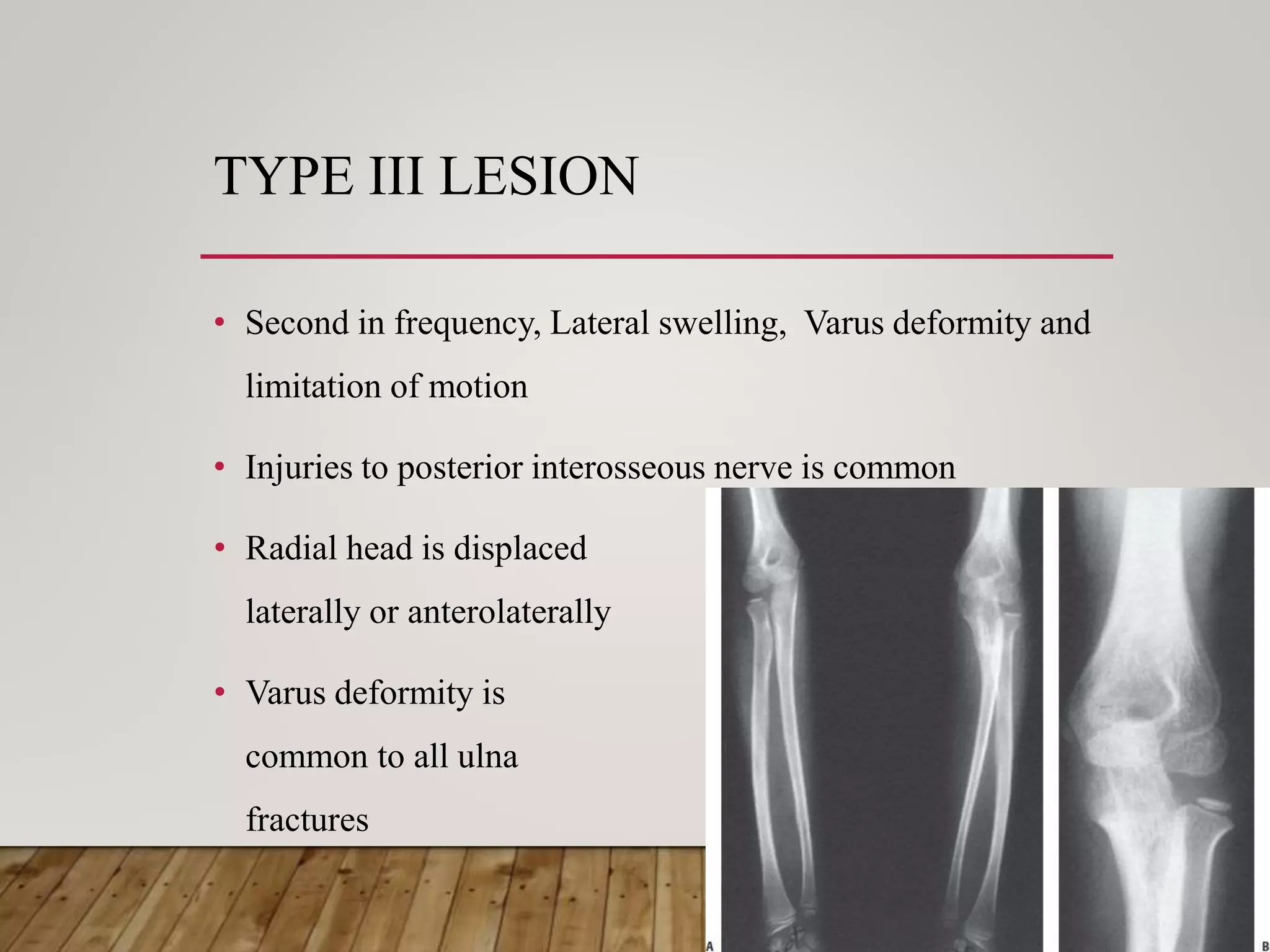 Monteggia fracture dislocation | PPTX