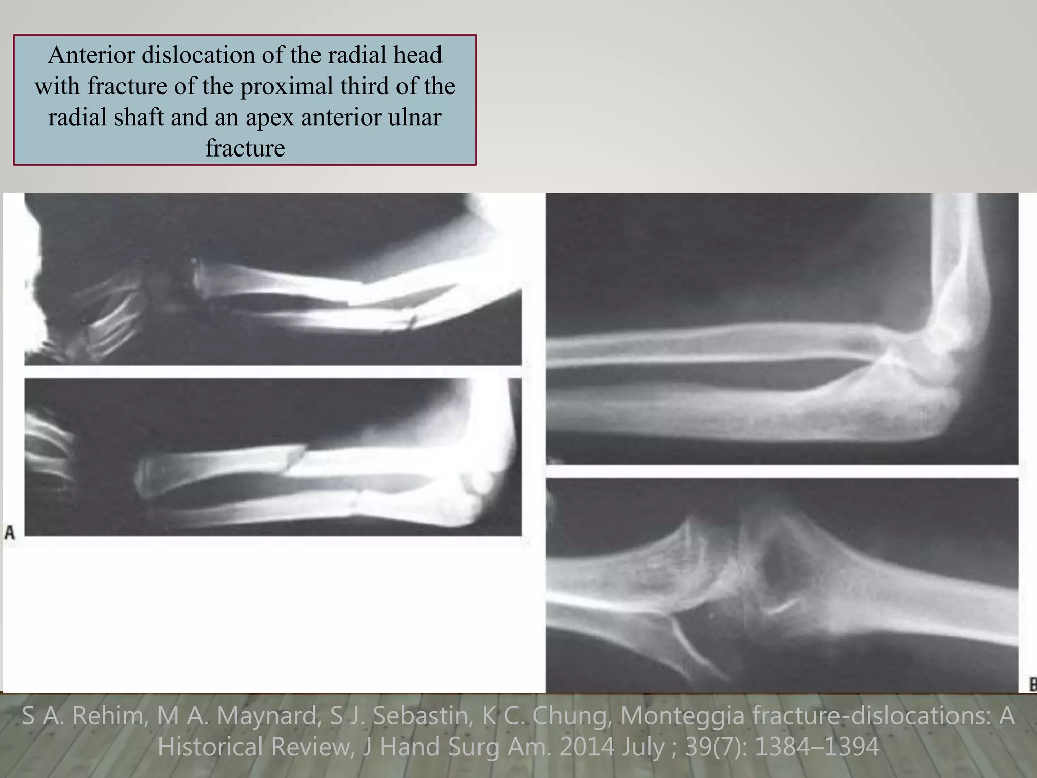 Monteggia fracture dislocation | PPTX