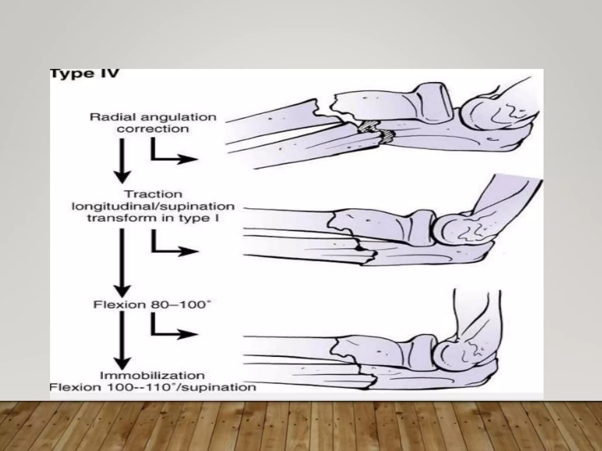 Monteggia Fracture Dislocation Ppt