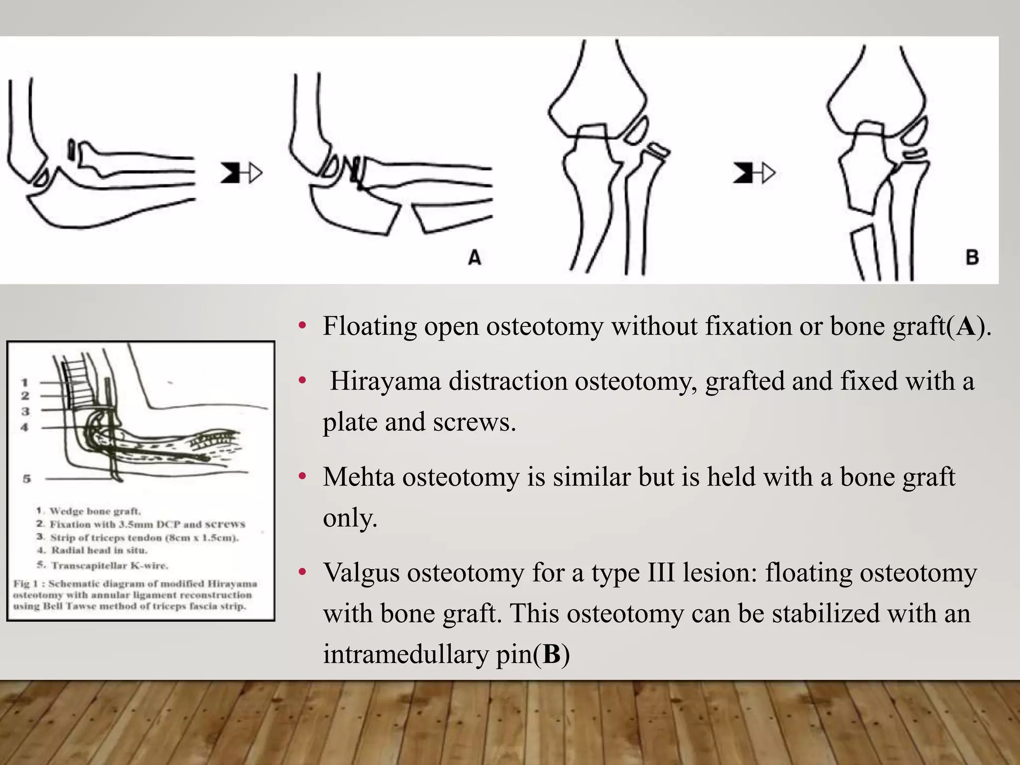 Monteggia fracture dislocation | PPTX