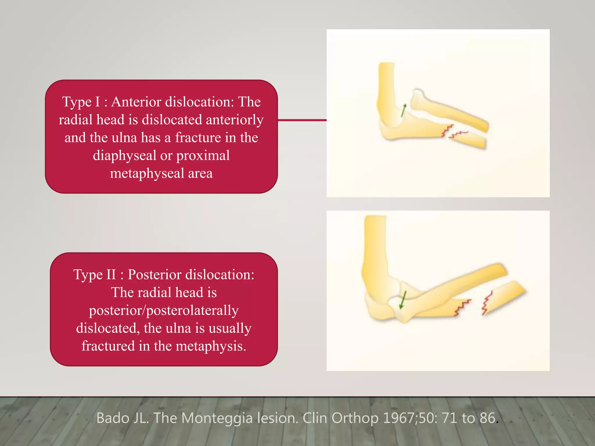 Monteggia fracture dislocation | PPTX