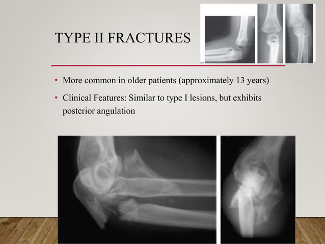 Monteggia Fracture Dislocation Ppt