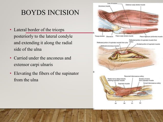 Monteggia Fracture Dislocation Ppt
