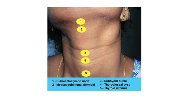 Final ppt neck swelling.pptx | Thyroid Disorders | Endocrine and ...