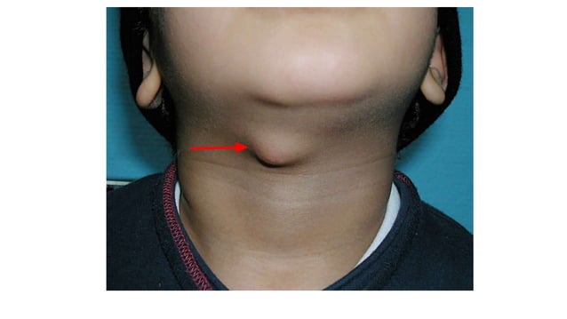 Final ppt neck swelling.pptx | Thyroid Disorders | Endocrine and ...