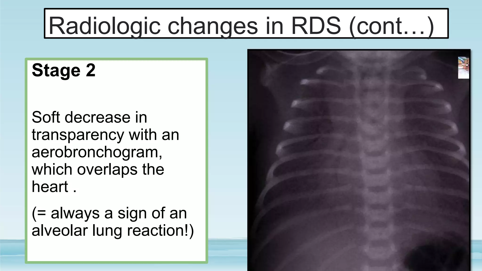 Respiratory physiology & Respiratory Distress syndrome in a newborn. | PPSX