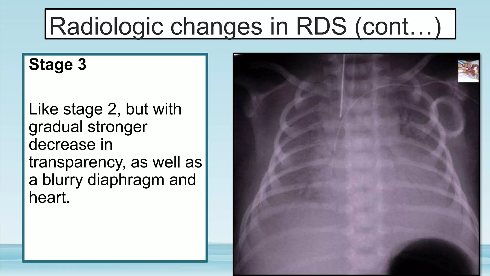 Respiratory physiology & Respiratory Distress syndrome in a newborn. | PPSX