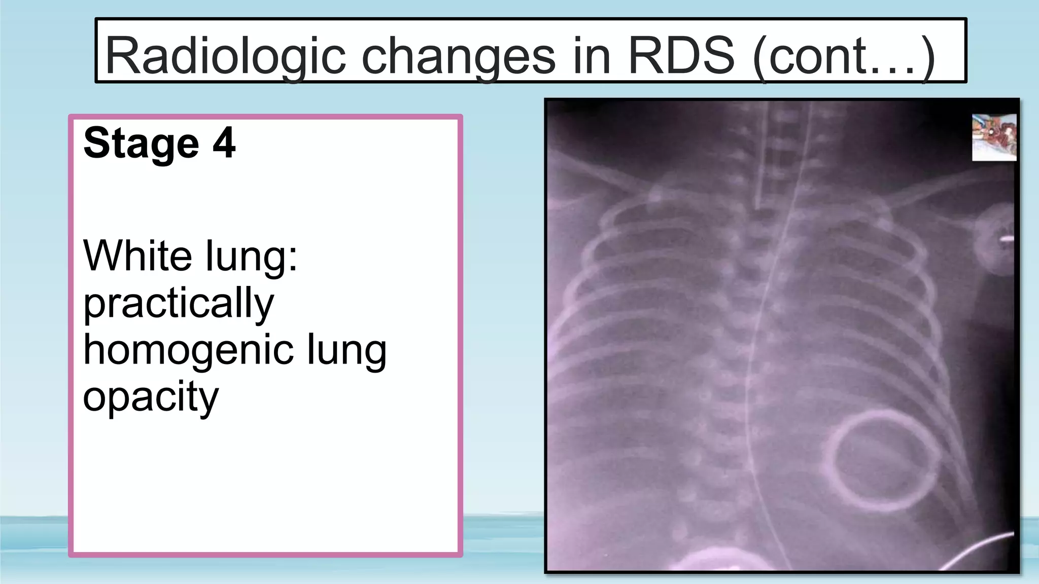 Respiratory physiology & Respiratory Distress syndrome in a newborn. | PPSX
