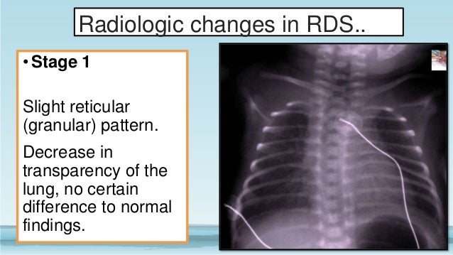 Respiratory physiology & Respiratory Distress syndrome in a newborn.