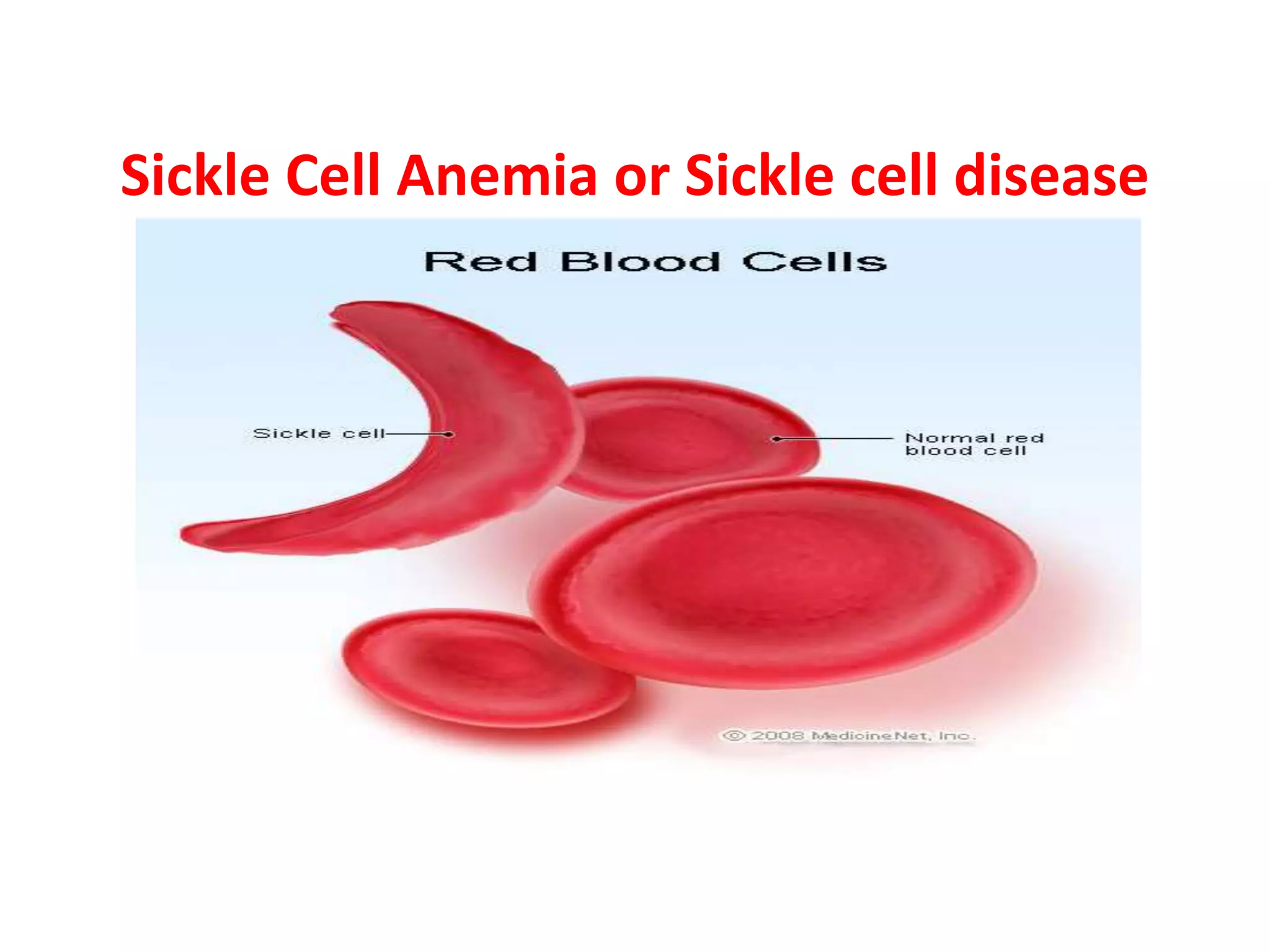 Final ppt sickle cell | PPTX