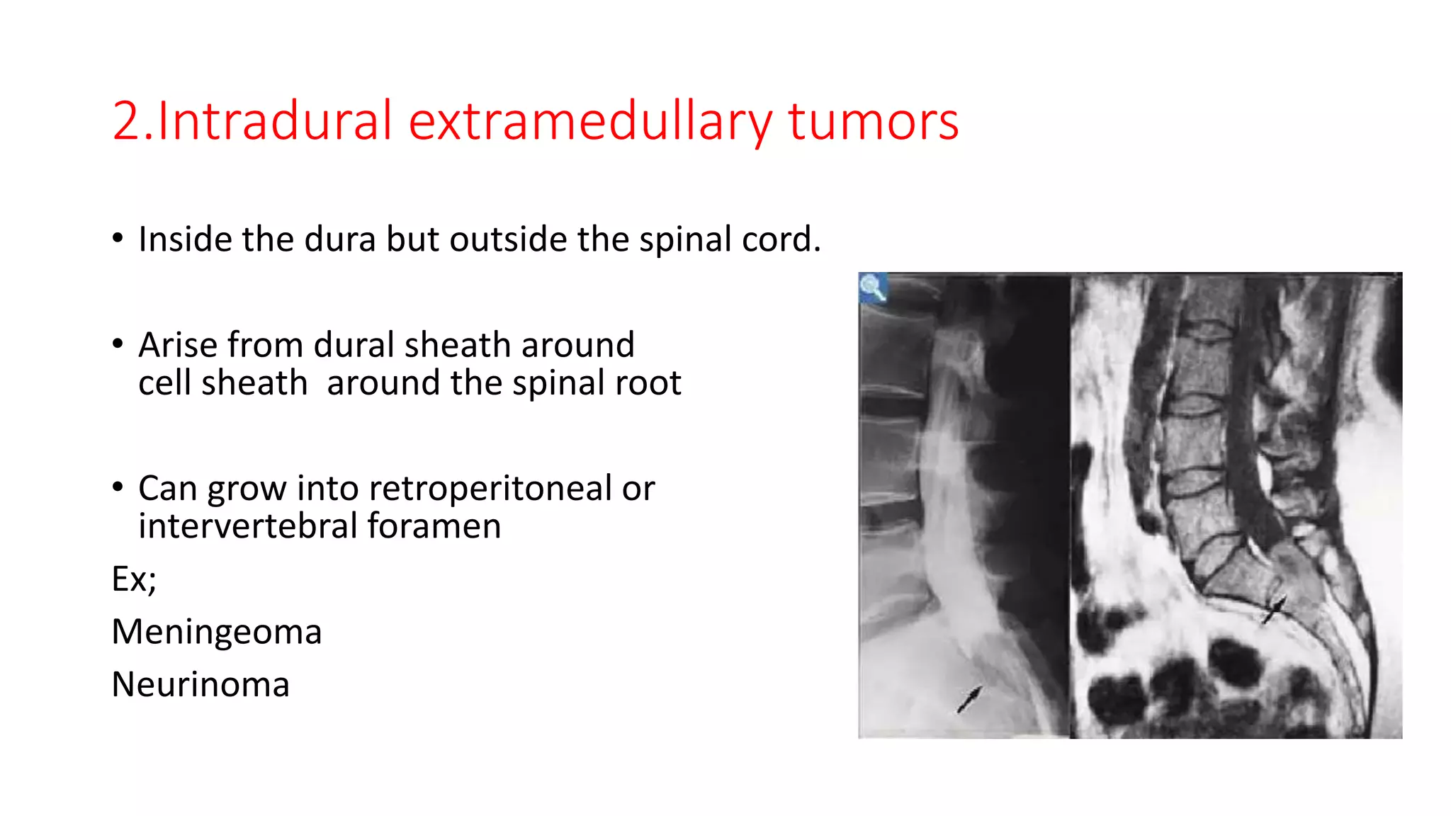 Spinal cord disorders.pptx