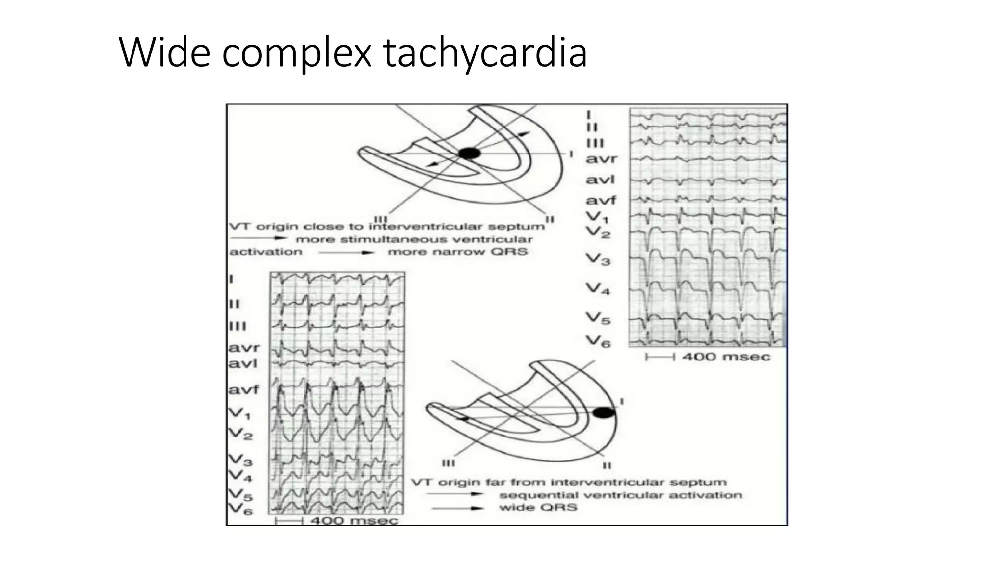 wide complex tachycardia.pptx