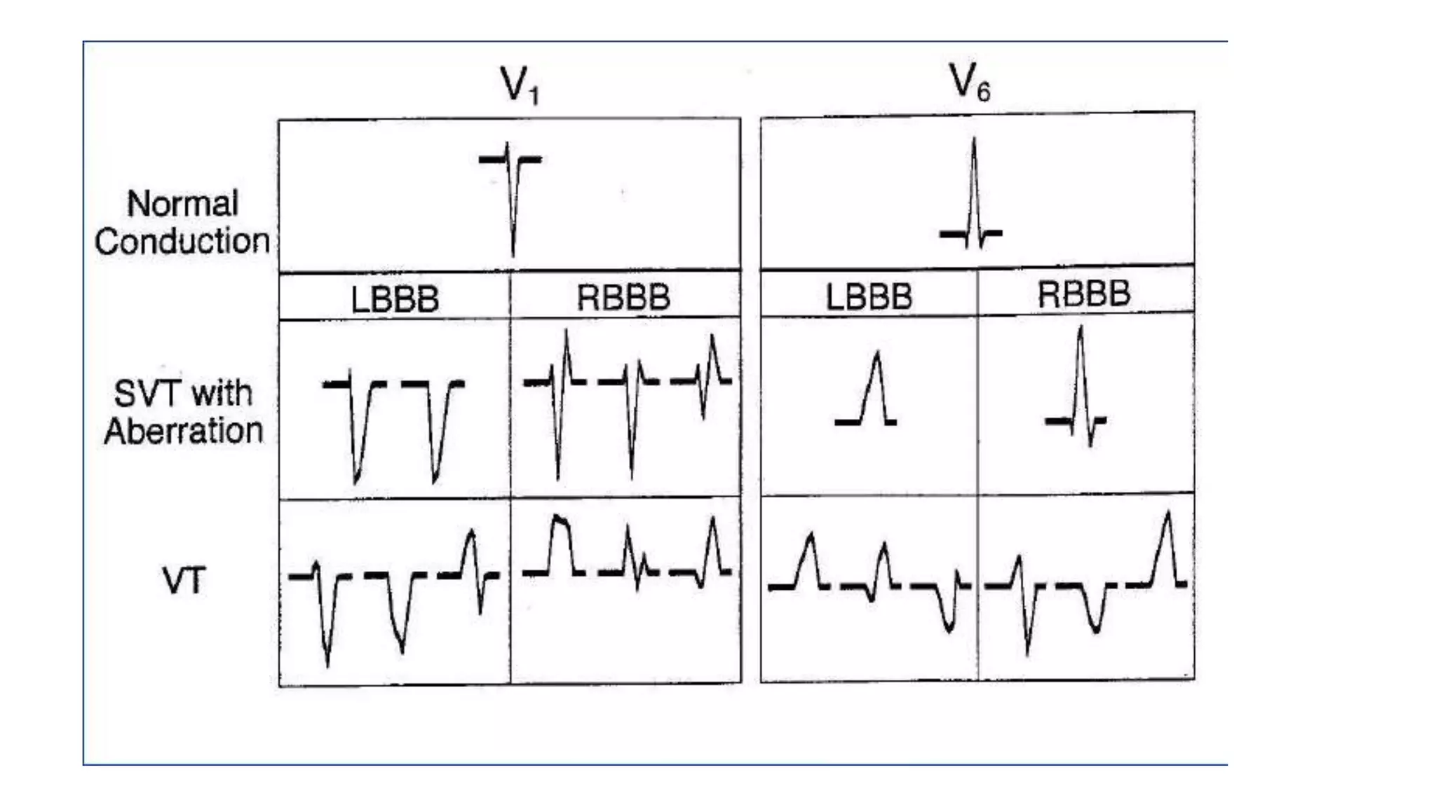 wide complex tachycardia.pptx