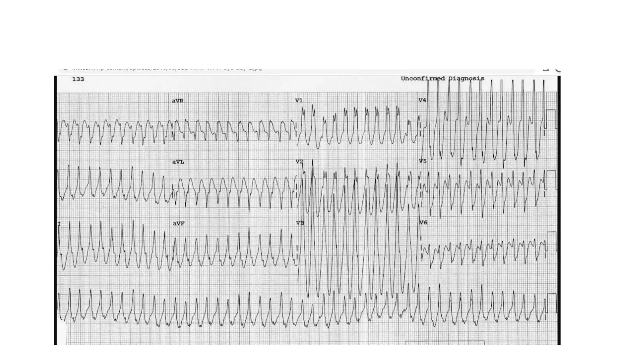 wide complex tachycardia.pptx