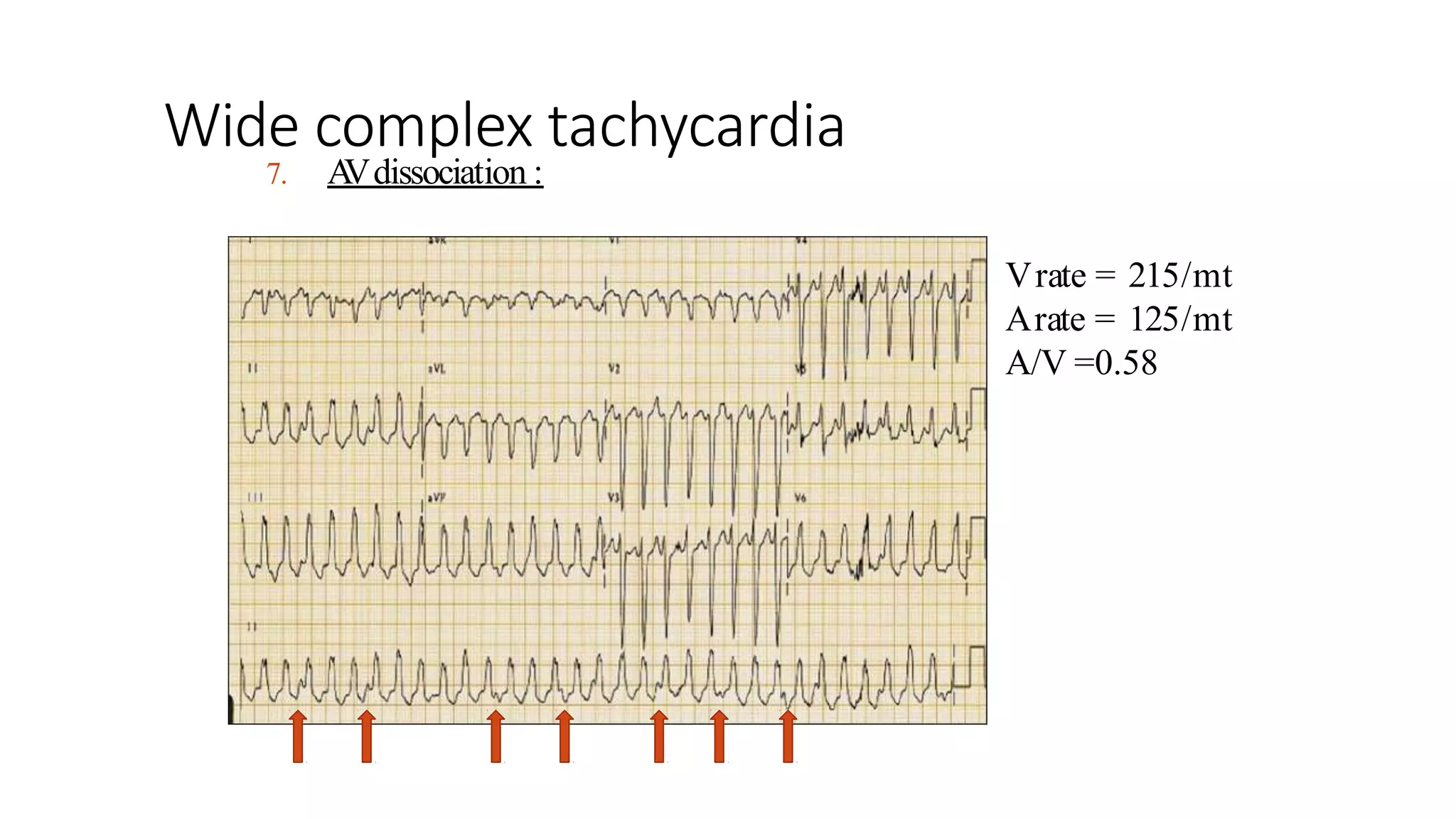 wide complex tachycardia.pptx