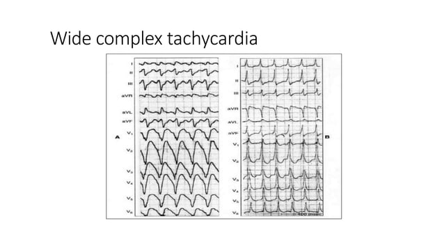 wide complex tachycardia.pptx