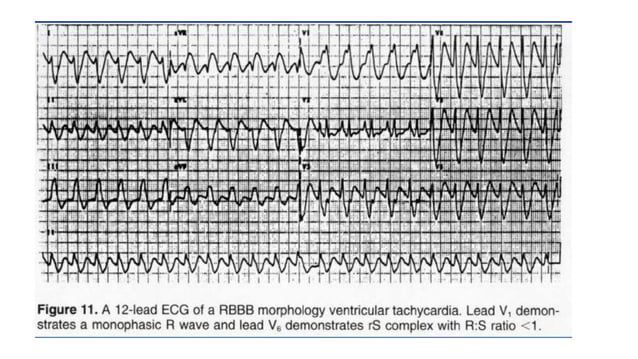 wide complex tachycardia.pptx