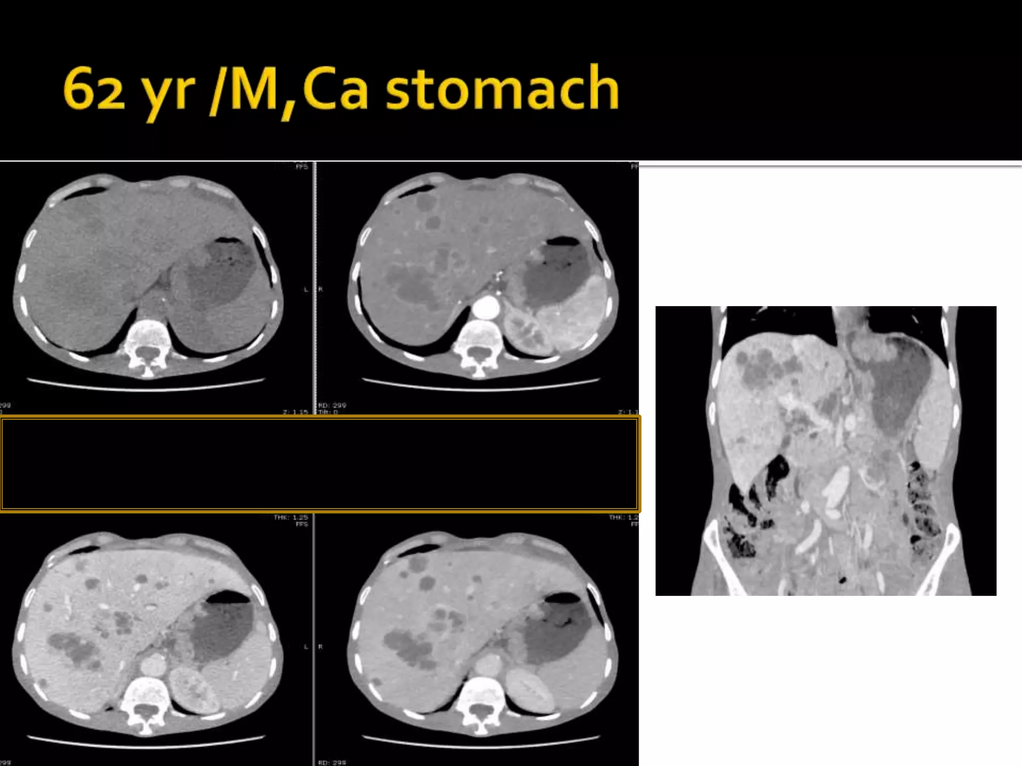 CT and MRI Imaging of Hepatic metastases | PPTX