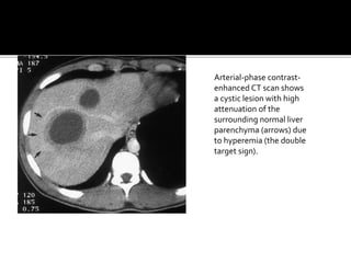 CT and MRI Imaging of Hepatic metastases | PPTX