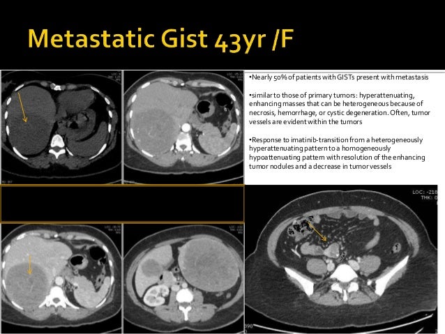 CT and MRI Imaging of Hepatic metastases