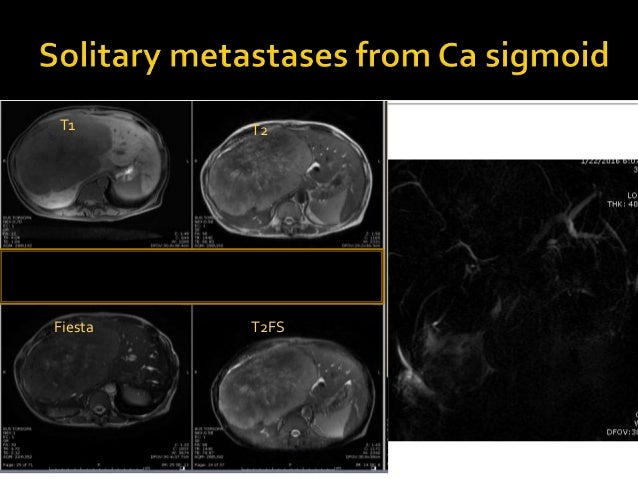 CT and MRI Imaging of Hepatic metastases