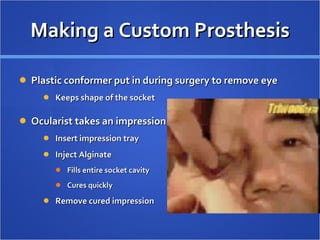 Making of an Eye | PPT