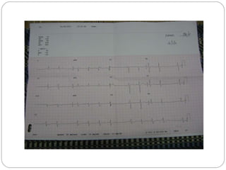 ECG: Type II Second degree SA Block | PPT