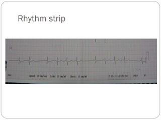 ECG: Type II Second degree SA Block | PPT
