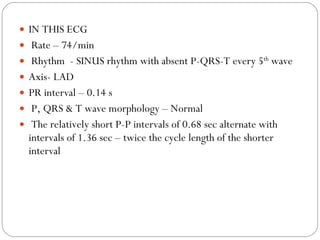ECG: Type II Second degree SA Block | PPT