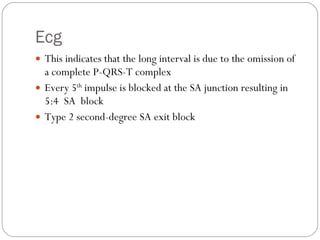 ECG: Type II Second degree SA Block | PPT