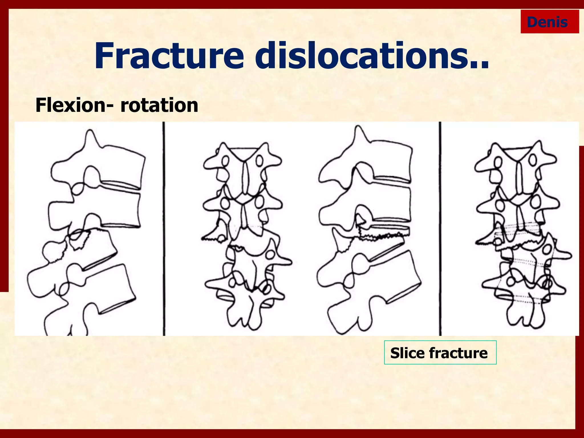 thoracolumbar spinal trauma | PPTX