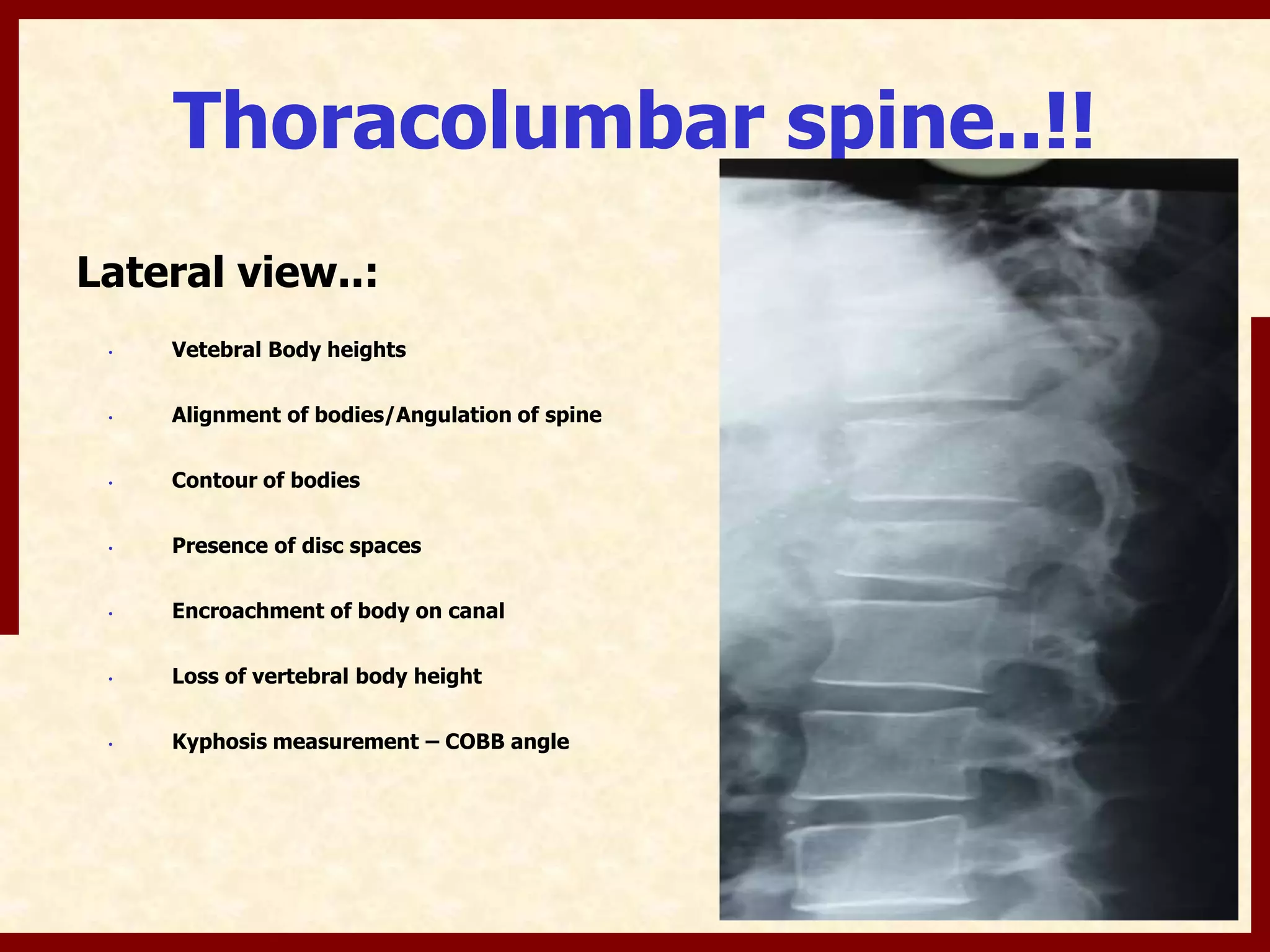 thoracolumbar spinal trauma | PPTX