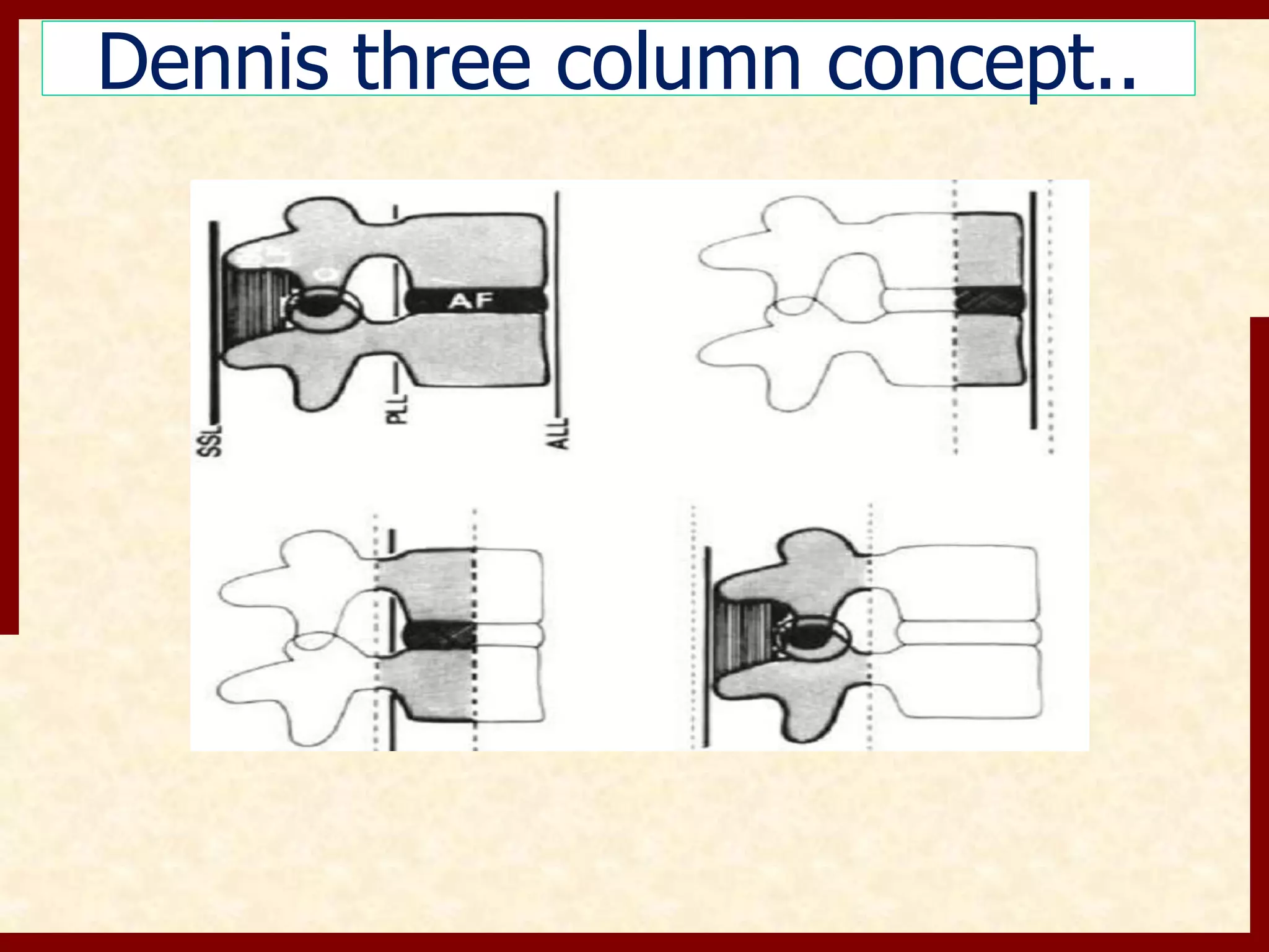 thoracolumbar spinal trauma | PPTX