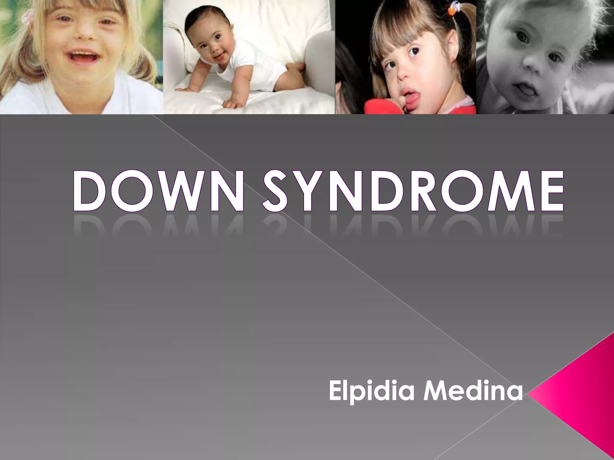 Down Syndrome Presentation | PPTX