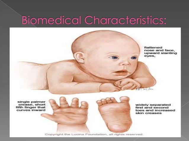 Down Syndrome Presentation | PPTX