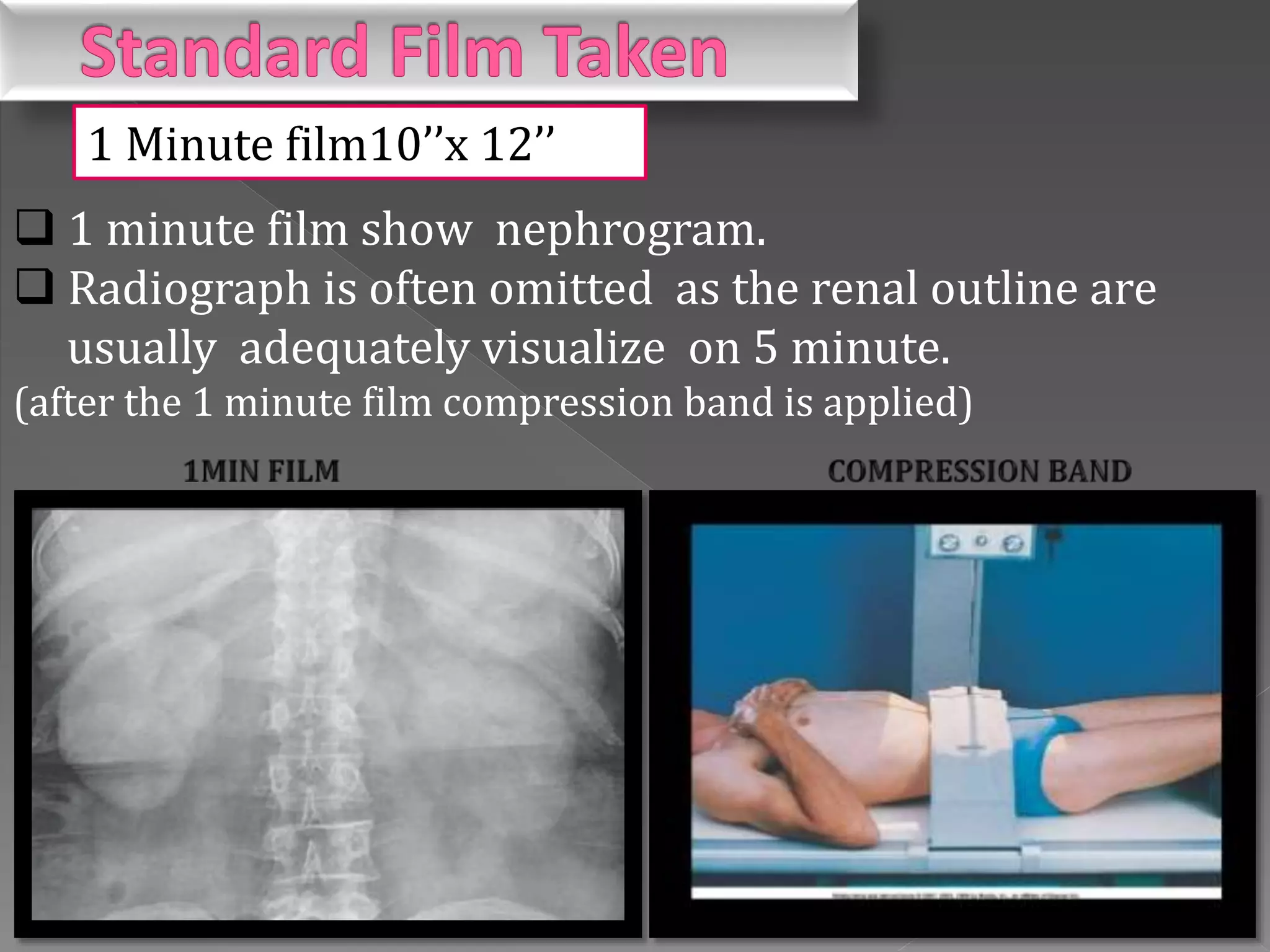 INTRAVENOUS UROGRAM | PPTX