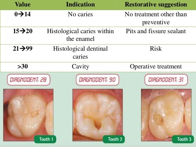 Preventive Dentistry and Early Caries Detection