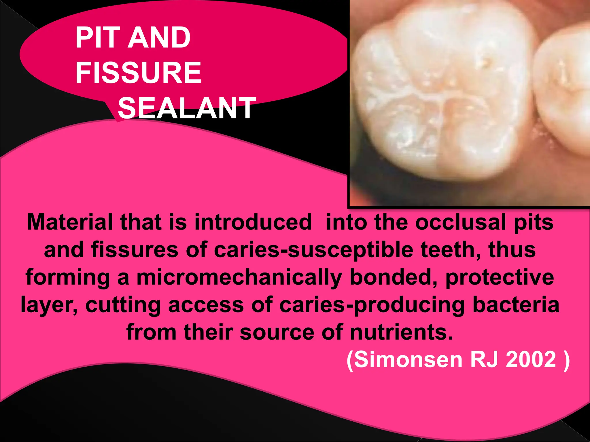 final prof lecture on pit and fissure sealant.pptx
