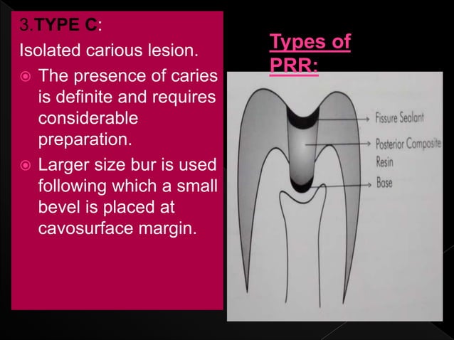 final prof lecture on pit and fissure sealant.pptx