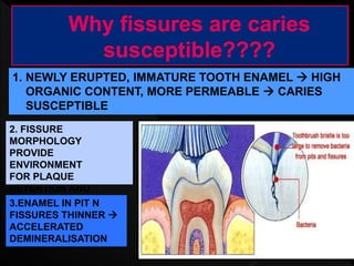 final prof lecture on pit and fissure sealant.pptx
