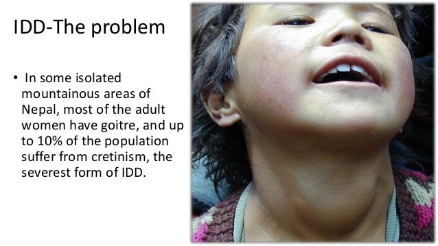 Iodine Deficiency Disorders