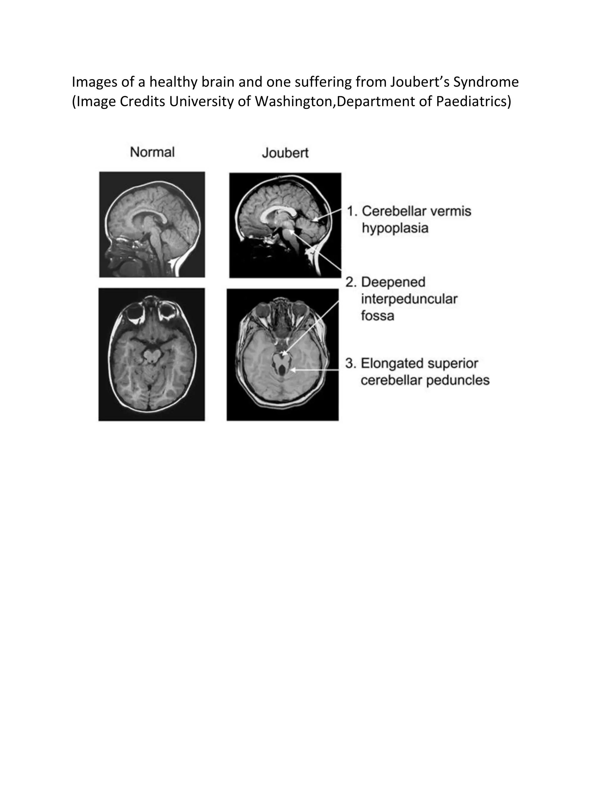 Joubert's Syndrome | PDF